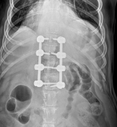 Pedicle screw fixation course - Orthomed